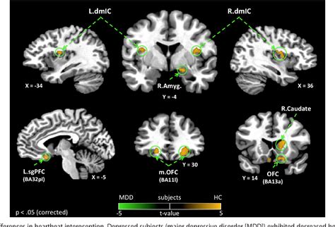 Figure 1 From Major Depressive Disorder Is Associated With Abnormal Interoceptive Activity And