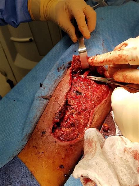 Treatment Of Soft Tissue Necrosis On The Leg Caused By Compartment