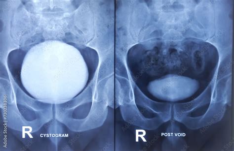 X Ray Film Of Rgu And Mcu Retrograde Urethrogram And Micturating Cystogram Radiological Test