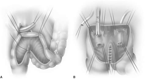 Use Of Bowel In Lower Urinary Tract Reconstruction In Women Abdominal Key