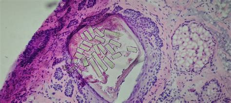 Some Interesting Crystalline Structures In Some Cysts On A Mohs Slide A