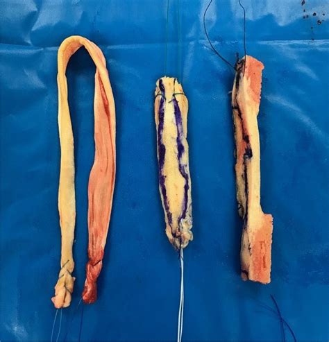 Examples Of Each Graft Harvest From Left To Right 4 Strand Hamstring Download Scientific