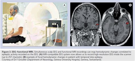 Imaging Techniques For Presurgical Evaluation Of Temporal Lobe Epilepsy