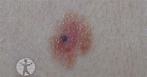 Combined Naevus Image