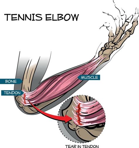 7 Common Extensor Tendon Stock Vectors And Vector Art Shutterstock