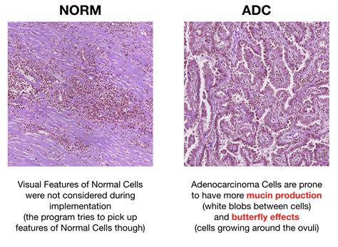 Lung Cancer Histology Image Classification With Convolutional Neural Network Index General