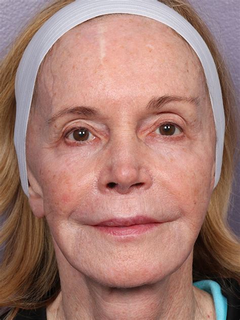 Before After Laser Contour Los Angeles CA Marina Med Spa