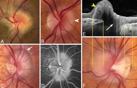 Pseudopapilledema Without Drusen A Tilted Optic Disc Syndrome With Download Scientific