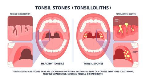 Tonsil Stones All You Need To Know London Ent