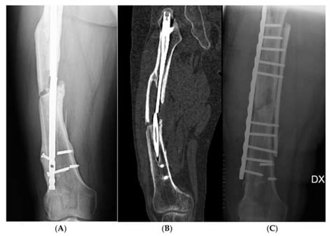 Treatment Of Femoral Shaft Pseudarthrosis Case Series And Medico Legal Implications