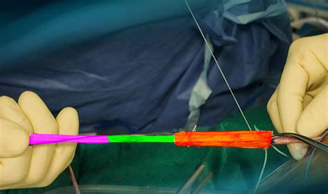 Continous Acl Lcl Plc Graft And Reinsertion Of Lateral Damaged Structure