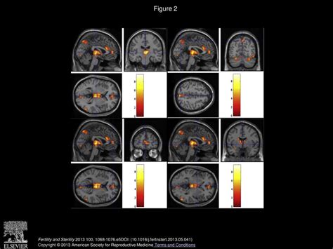 Brain Activation Patterns In Women With Acquired Hypoactive Sexual Desire Disorder And Women