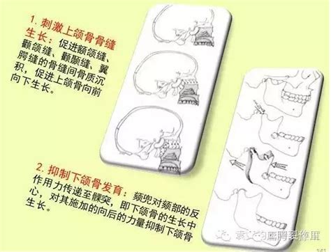 唇腭裂患儿乳牙期的早期矫正 唇腭裂咨询网