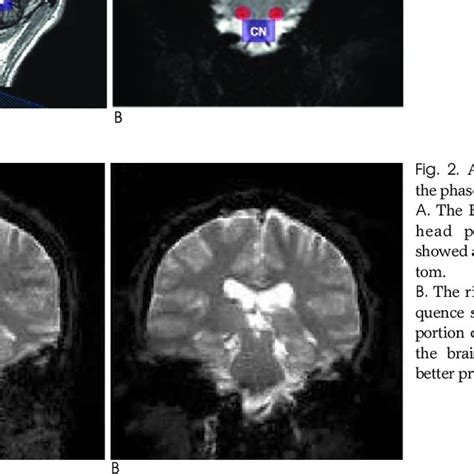 Pdf Using Fmri To Detect Activation Of The Cortical And Subcortical