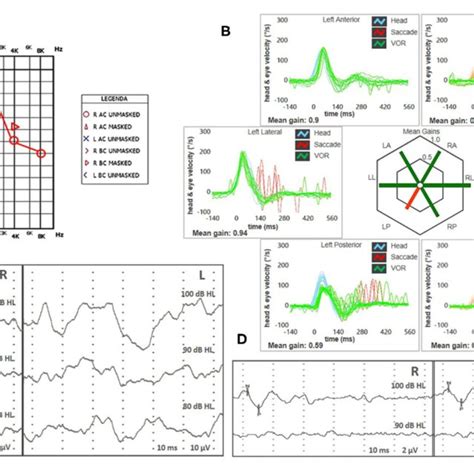 Ocular Tilt Reaction Graviceptive Pathways From The Utricle And