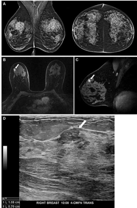 Mammography Based Deep Learning Model Facilitates Higher Breast Cancer Detection On Screening Mri