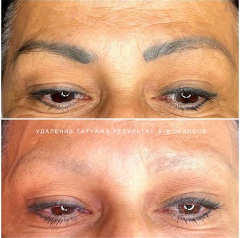 Лазерне видалення перманентного макіяжу Kovalova Laser