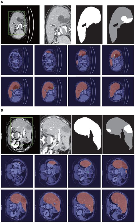 liver segmentation results based on ra unet ii a from the lits