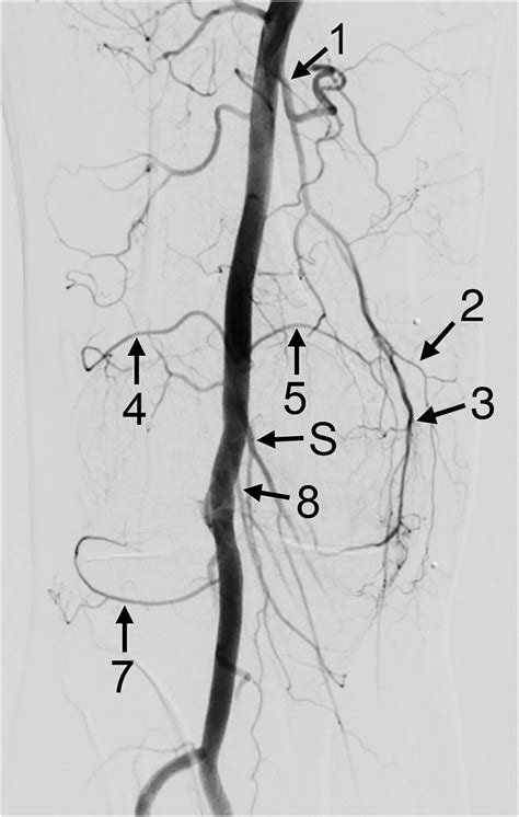 Jvir Access Gae Anatomy Considerations