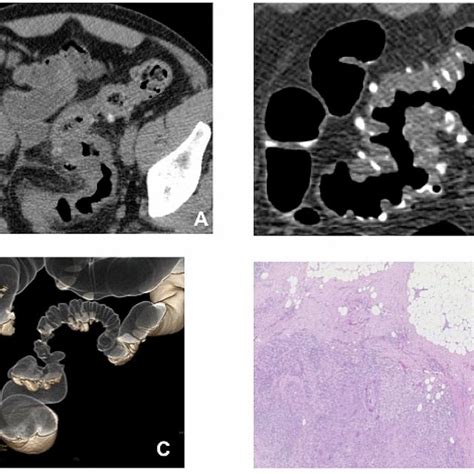 The Voi Extraction For A 6 Mm Sessile Polyp In A Sigmoid Colon A The Download Scientific