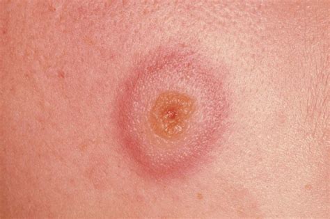 Erythema Multiforme Nhs