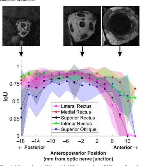 Figure 7 From Deep Learning Based Segmentation Of Extraocular Muscles