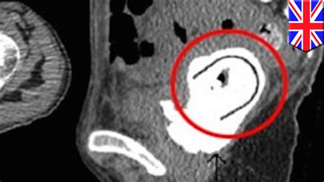 Babae Sampung Taong Nakalimutan Ang Sex Toy Sa Loob Ng Kanyang Vagina