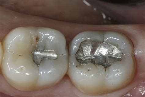 Replacing Amalgam With Composite May 2011 Inside Dentistry