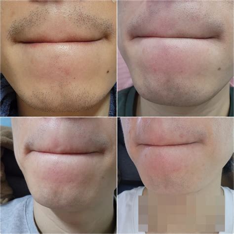 남자 수염 제모 17회차 후기 클라리티2 레이저 The Mens Grooming