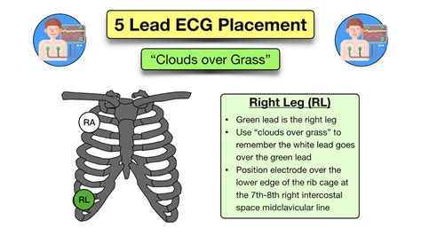 12 Lead Ecg Placement Diagram And Mnemonic For Limb And 41 Off
