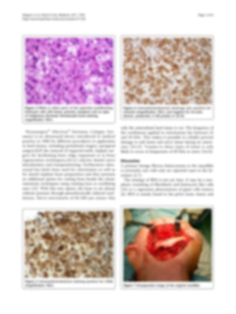 Solution Piezoelectric Assisted Removal Of A Benign Fibrous Histiocytoma Of The Mandible An