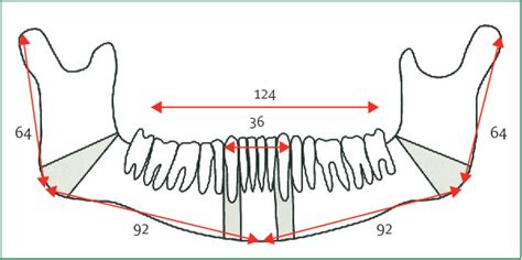 Figure 1 From A New Classification For Mandibular Defects After