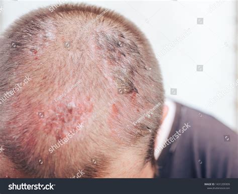 Closeup Irritation Rash On Human Scalp Stock Photo Shutterstock