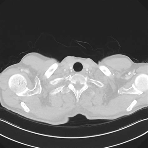 Apical Pleural Calcification Radiopaedia 46141 50499 Axial Lung Window