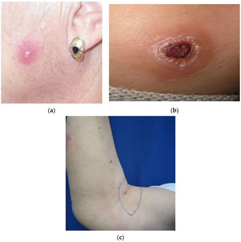 Cutaneous Leishmaniasis