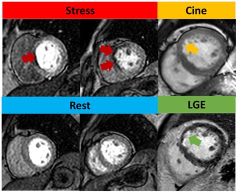 Qualitative And Quantitative Stress Perfusion Cardiac Magnetic