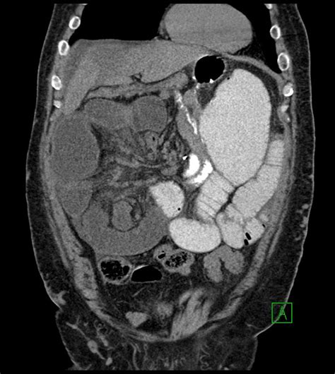 Closed Loop Small Bowel Obstruction Internal Hernia Radiopaedia 78439