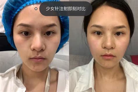 少女针，童颜针区别是什么？想要抗衰到底该怎么选？ 知乎
