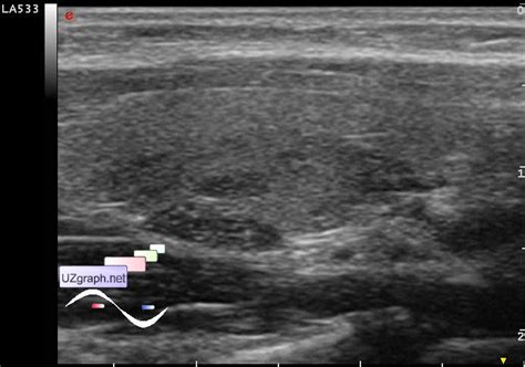 Focal Thyroiditis Plus Thyroid Gland Sonography Clinical Report