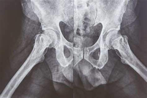 Total Vs Partial Hip Replacement Differences And Selection Criteria