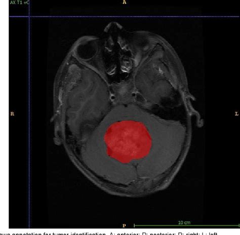 Figure 1 From Deep Learning Based Clinico Radiological Model For Paediatric Brain Tumor