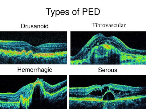 PPT Interpretation Of SD OCT PowerPoint Presentation Free Download ID