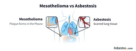 Asbestosis Vs Mesothelioma I Key Differences