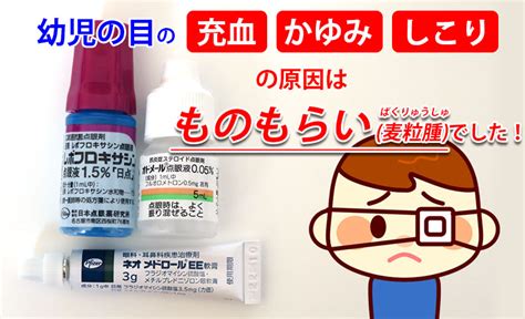 目の充血かゆみしこりの原因はものもらい麦粒腫でした みゆ何でもブログ