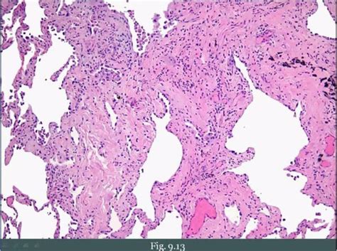 Resp E1 Restrictive Lung Stuff Flashcards Quizlet