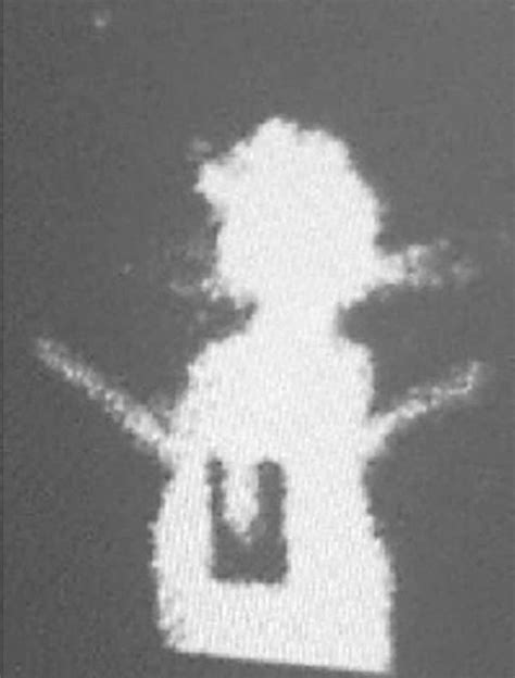 Evaluation Of The Flap With Technetium 99m Scintigraphy Dynamic View Download Scientific