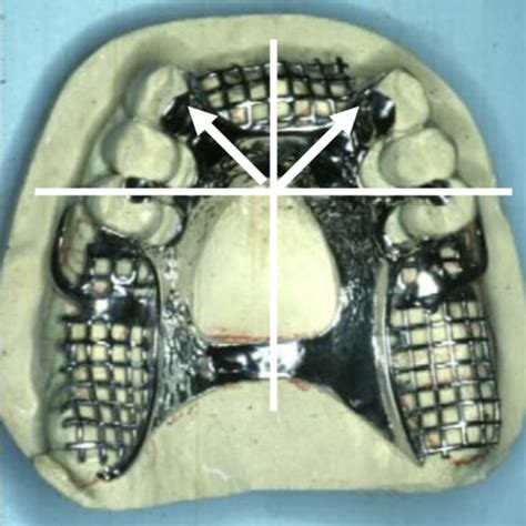 Kennedy Class I Flashcards Quizlet