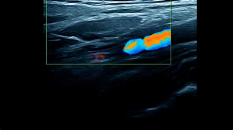 Soft Tissue Ultrasound The Ultrasound Suite
