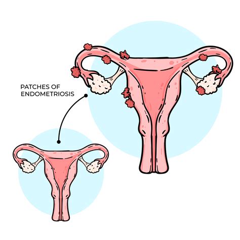 Common Gynaecological Disorders In Women