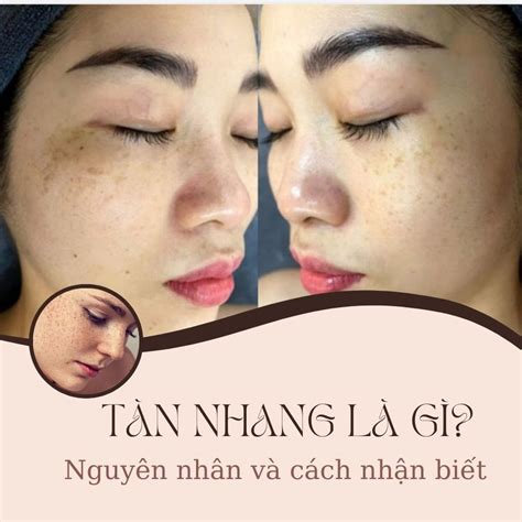 Phân Biệt Nám Và Tàn Nhang Cách Nhận Biết Và Điều Trị Hiệu Quả Nc